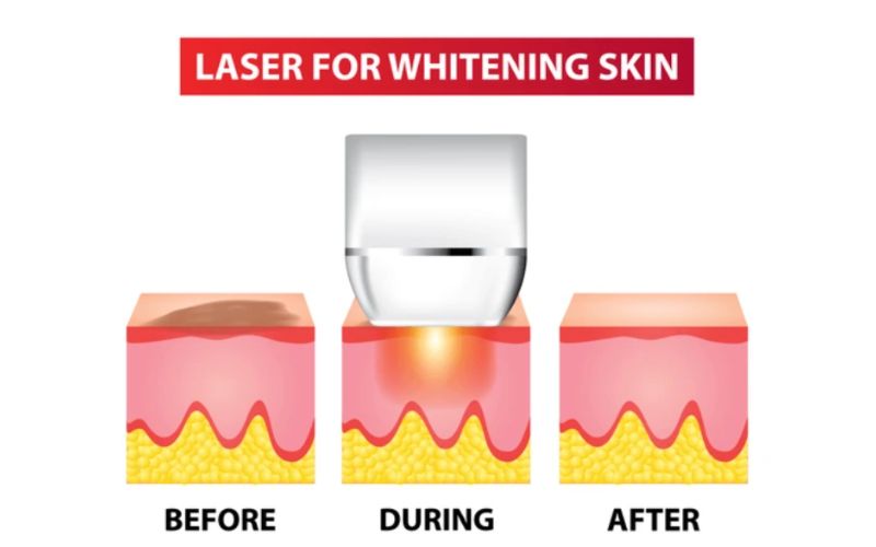 Goodbye Dark Spot: Effective Laser Skin Lightening Explained